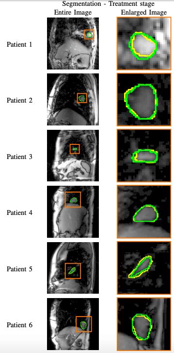 Real Time Lung Tumor Tracking Using A Cuda Enabled Nonrigid Registration Algorithm For Mri