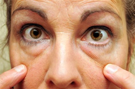Tips To Get Rid Of Bags Under Your Eyes