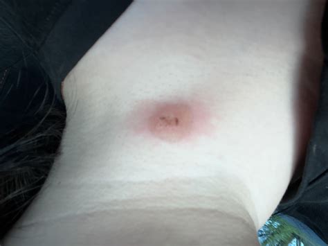 Сначала появилась шишка болезненная а сейчас как язва на шее Проснулась Medaboutme