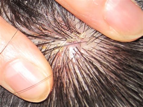 Natural And Alternative Treatments For Scalp Psoriasis RemedyGrove
