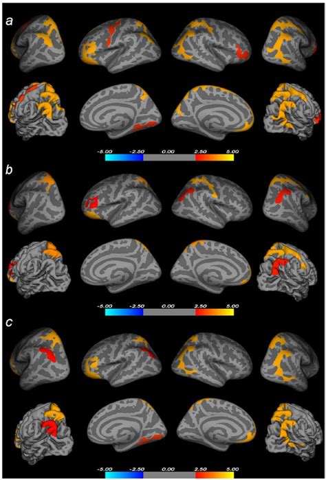 Statistical Maps Of The Interaction Contrasts A Diagnosis