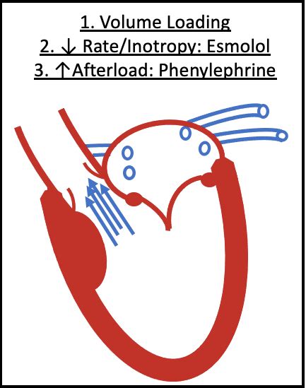 Left Ventricular Outflow Tract Obstruction Lvoto And Sam