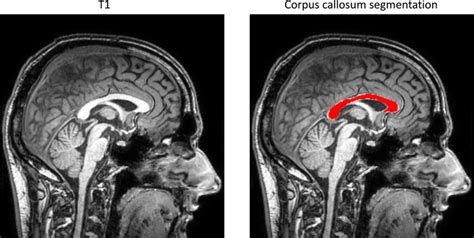 corpus callosum segmentation in the cneuro® quantification tool