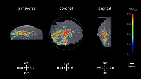 Imaging Case 12 Breast Cancer Invasive Ductal Carcinoma