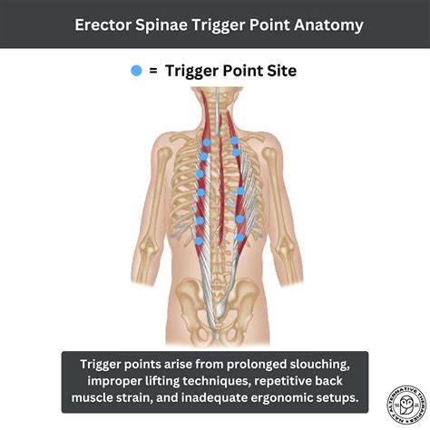 Trigger Points Erector Spinae Muscle Nat Global Campus Facebook