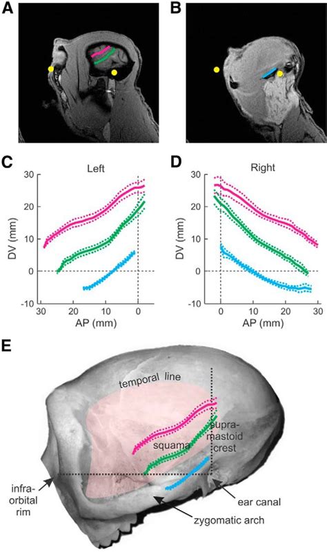 Irresti Superior Temporal Cortical Regions