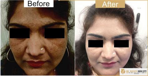 Black Spot On Face
