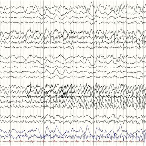 Pdf Improving The Ability Of Ed Physicians To Identify Subclinical Electrographic Seizures On