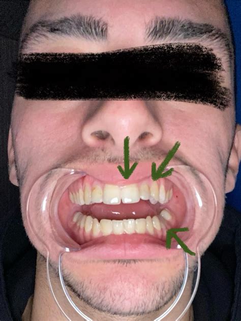 Please Give Me Some Advice🙏 Rorthotropics