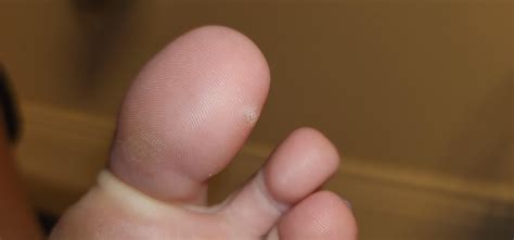 Hard Bump On Toe R Dermatologyquestions
