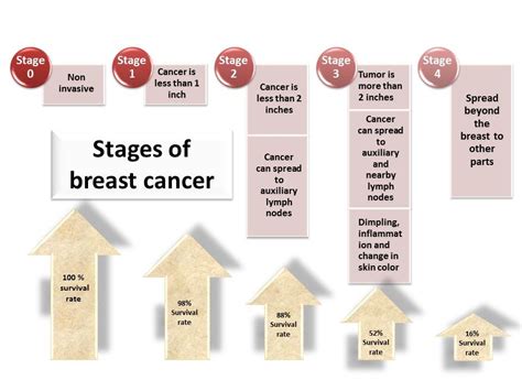 Breast Cancer Stages Explained A Comprehensive Guide Pkygd