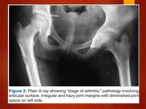 Tuberculosis Of Hip Joint Ppt
