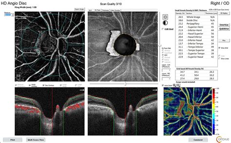 Effect Of Myopia On Vessel Density In Glaucomatous Patients Opth