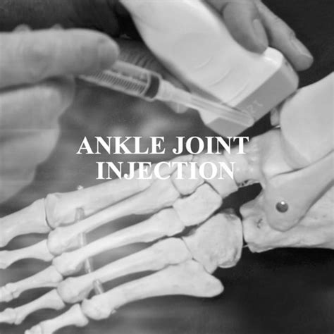 Ankle Tibiotalar Joint Injection Must Msk Ultrasound
