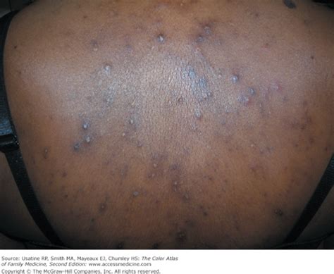 Folliculitis Basicmedical Key