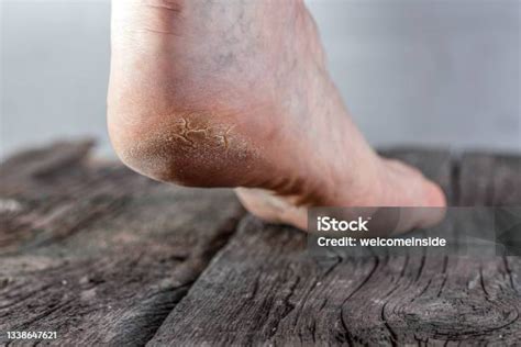 금이 발 뒤꿈치 여자 또는 남자 발 발 뒤꿈치에 피부 균열 선택적 초점 건강한 생활방식에 대한 스톡 사진 및 기타 이미지 건강한 생활방식 건조한 균류 Istock