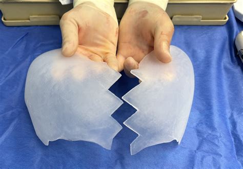 Split Custom Foerehead0 Temporal Design Open Dr Barry Eppley Explore Plastic Surgery