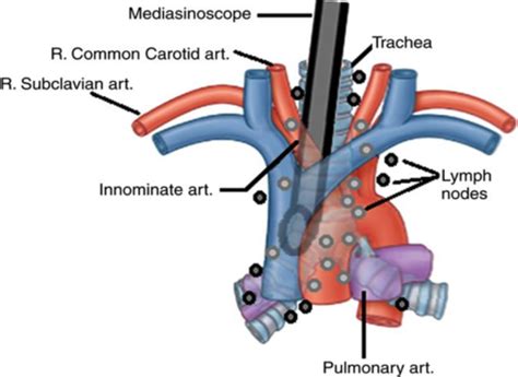 Pulmonary Function Tests Pulmonary Procedures Cancer Screening X Flashcards Quizlet