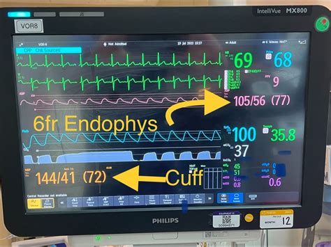 Steve Leonard Rt R Vi Ci On Linkedin This Was A Pcom Aneurysm