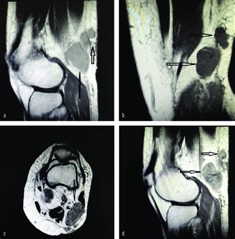 Magnetic Resonance Imaging Of Knee And Popliteal Fossa Synovial