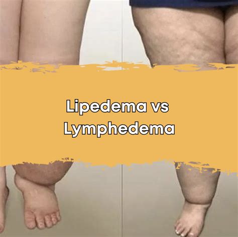 Lipedema Vs Lymphedema Symptoms Causes And Key Differences Lipedema