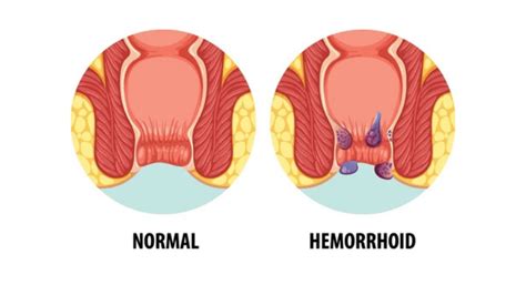 Hemorrhoid Symptoms Swelling