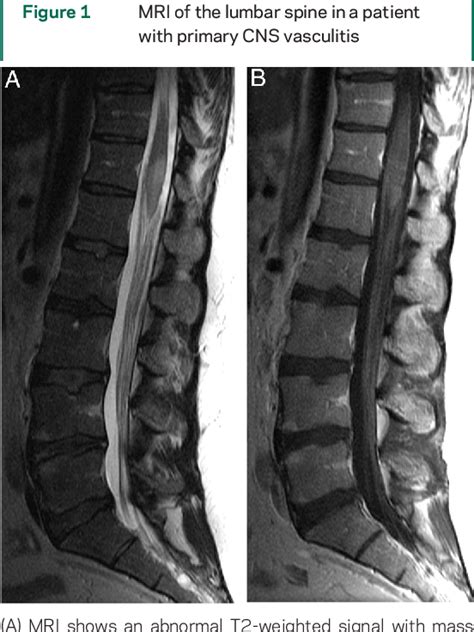 Figure 1 From Primary Cns Vasculitis With Spinal Cord Involvement Semantic Scholar