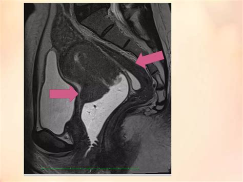 Urology Gynecology Mri Staging For Ca Cervix Pdf