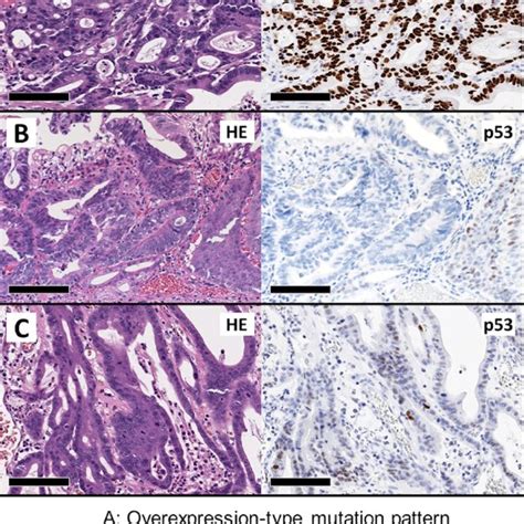 Experimental Results For P53 Staining A Overexpression Type Mutation Download Scientific