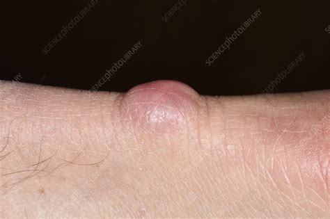 Angioleiomyoma Growth Stock Image C0498504 Science Photo Library