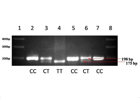 Rflp Analysis For The C677t Mutation On 198 Bp Mthfr Pcr Products With Download Scientific