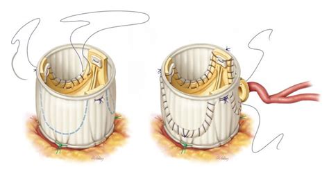 Technique For Replacing Aortic Root While Leaving Valve In Place