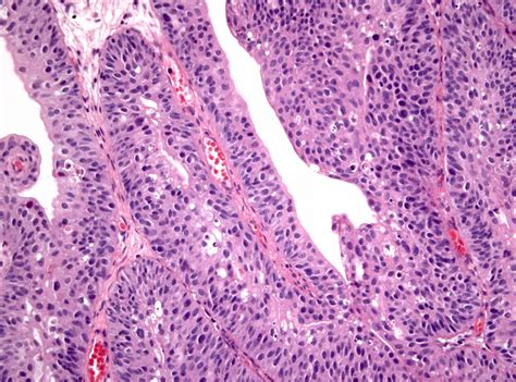 Pathology Outlines Grading Bladder