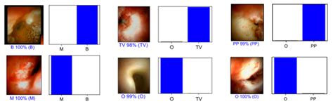 Deep Learning For Automatic Diagnosis And Morphologic Characterization Of Malignant Biliary