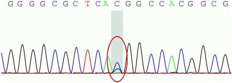 Genetic Mutation In The Pnpla2 Gene At Chromosome 11819873 Of The