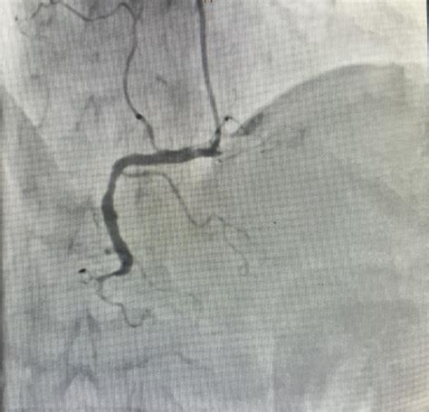 【医疗】我院心血管内科成功应用ivus为患者提供精准治疗 皖南医学院第二附属医院