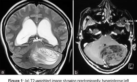 Figure 1 From Dysplastic Cerebellar Gangliocytoma Lhermitteduclos
