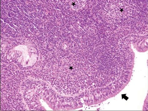 Nasopharynx Histology Virus Associated Neoplasms Of The Nasopharynx