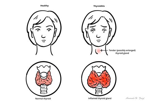 Thyroiditis Armando Hasudungan
