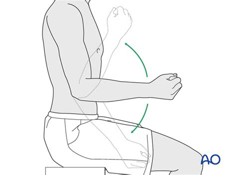 Open Reduction Internal Fixation For Anterior Transolecranon Fracture Dislocation