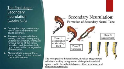 Spinal Dysraphism Pptx