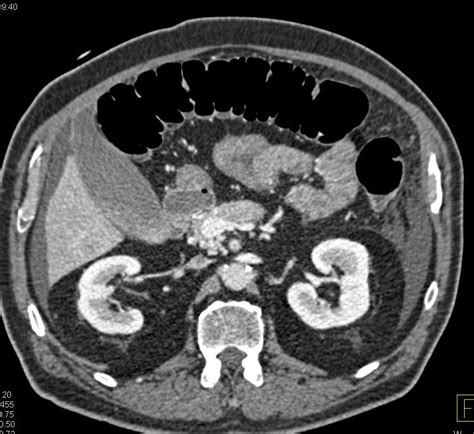 Carcinoid Tumor In The Root Of The Mesentery With Calcification And Encases Superior Mesenteric