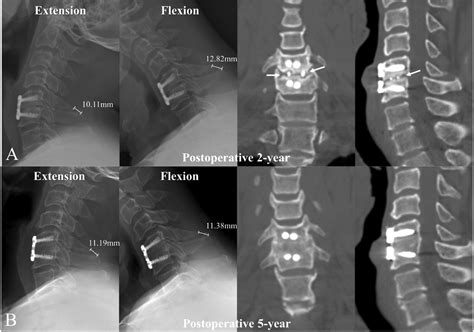 Fate Of Pseudarthrosis Detected 2 Years After Anterior Cervical Discectomy And Fusion Results