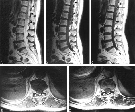 Spinal Epidural Hematoma