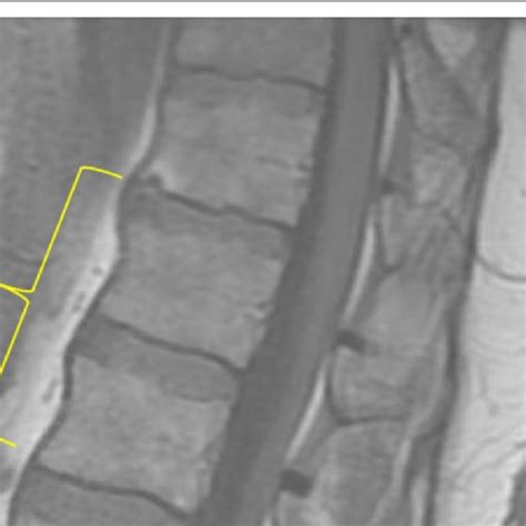 Patient With Generalized Blanchable Maculopapular And Morbilliform Rash