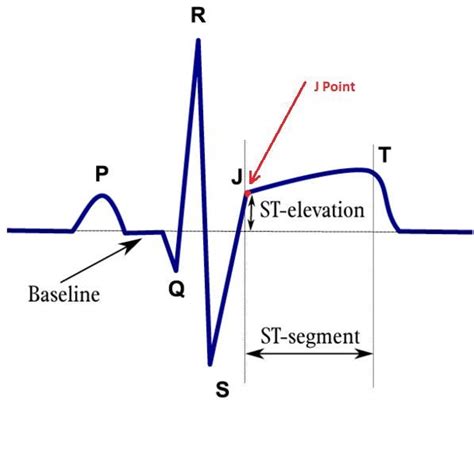 Code Stemi Activation For Paramedics V11 For Elearn 2023 By Clinical