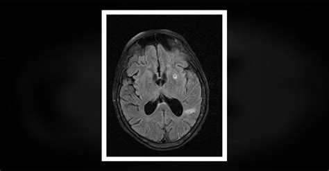 Navigating The Complexities Of Streptococcal Endocarditis Medsynapse