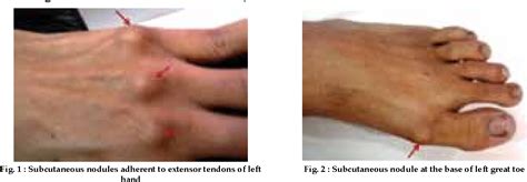 Rheumatoid Arthritis Nodules