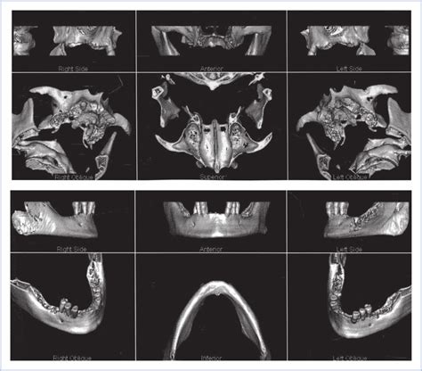 Three Dimensional Computerized Tomography Scan Showing How The Patient Download Scientific