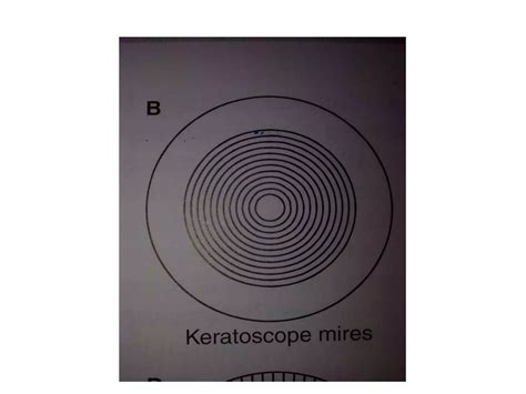 Corneal Topography Wavefront Analysis Pptx